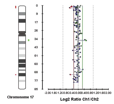 Array Cgh Analysis In Patient 3 Showing Significant Gain Of 17 Q12