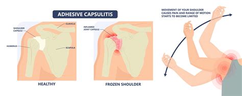 Adhesive Capsulitis Arthurcare