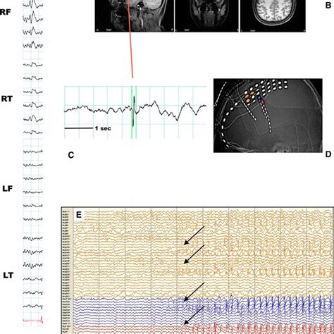 Meg Sensor Data Of An Interictal Spike Identified By The Samg2