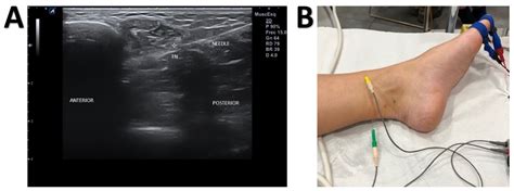 Baxters Nerve Block At Eula Garcia Blog