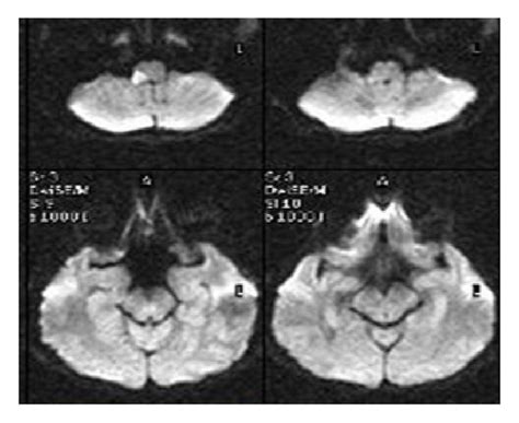 The Diffusion Restriction Which Led To The Acute Infarct Holding The