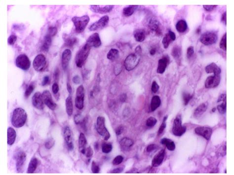 Histological Aspect Showing Polymorphous Cell Population With Malignant Download High