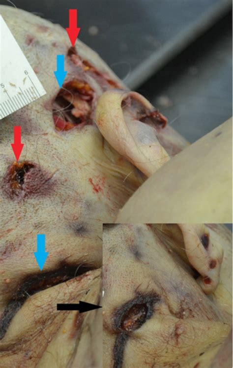 Bite Marks At 6 Cm Intervals With Bleeding Contours Compatible With