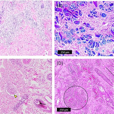 Microscopic Pathology Of The Skin Nodules Developed In Dermis Of Download Scientific Diagram