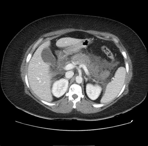 Acute Pancreatitis Balthazar E Radiopaedia 29016 29377 Axial C