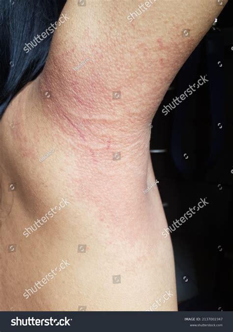 Psoriasis Armpit