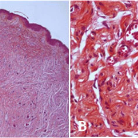 A Neurofibroma From The Skin Of The Mother HAS B Detail White Download Scientific