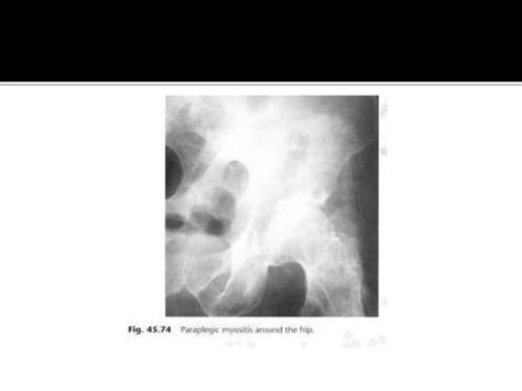 Ossification And Calcification Pptx Bone And Joint Conditions Diseases And Conditions