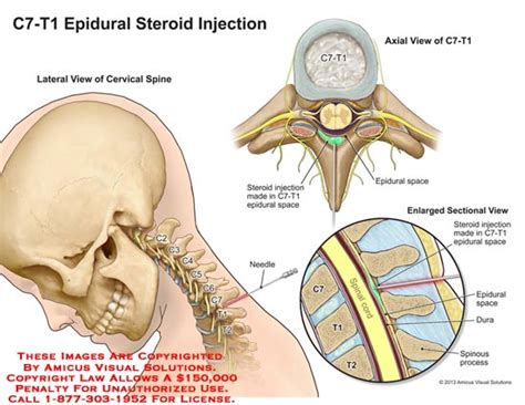 C7 T1 Epidural Steroid Injection