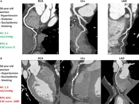 Sex Differences In Associations Of Arterial Compliance With Coronary
