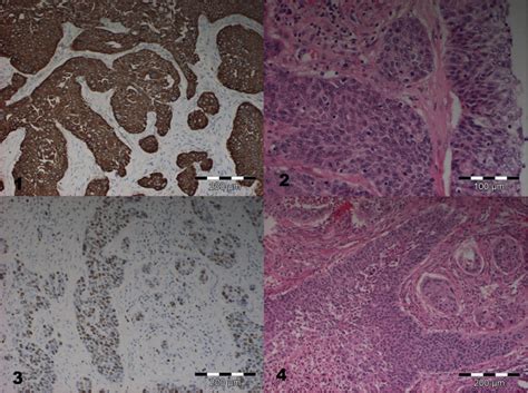 Skull Metastasis As A Primary Manifestation In Cervical Carcinoma