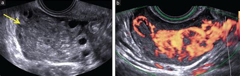 Choriocarcinoma Ultrasound