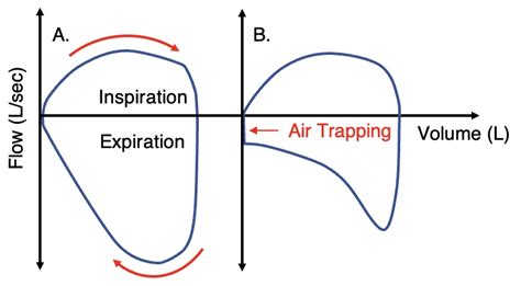 Ventilator Volume Loops Trauma Icu