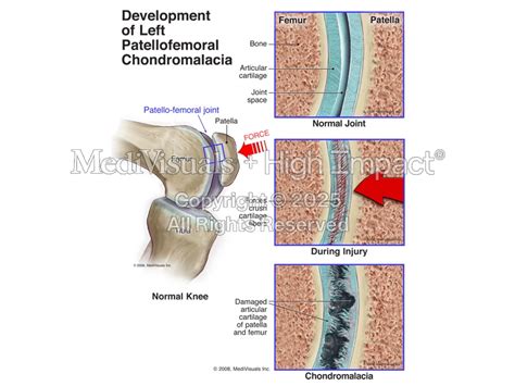 Development Of Patellofemoral Chondromalacia High Impact