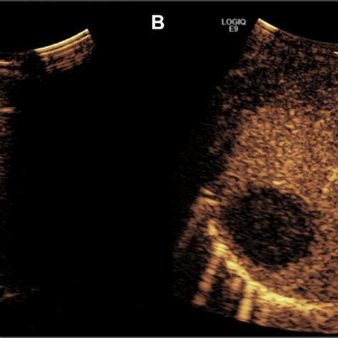 The Peak Intensities From 2d And 3d Contrast Enhanced Ultrasound 2