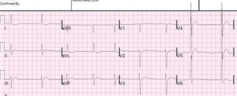 Coved St Elevation With Reciprocal St Depression What Is The Diagnosis