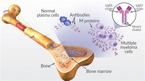 How To Cure Multiple Myeloma Plasma Cell Myeloma Allcancer