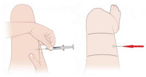 Диклофенак уколы инструкция по применению цена отзывы аналоги таблетки цена