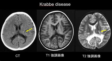 Diagnostic Imaging Of White Matter Abnormalities Congenital Cerebral