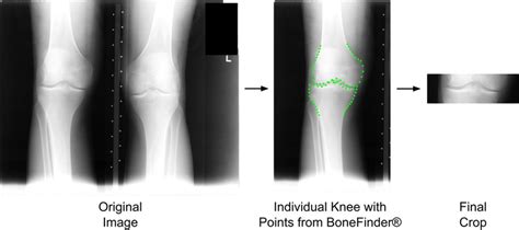 Preprocessing Steps Of Custom X Ray Model Download Scientific Diagram