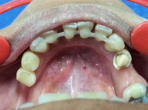 Teeth Splinting Shah Dental Specialists