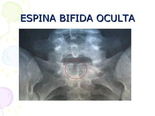 Espina Bífida Oculta Rayos X