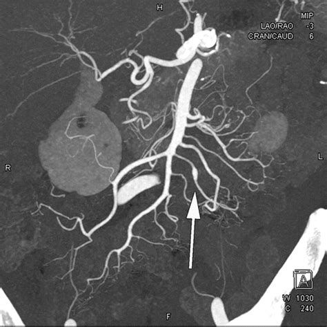 Superior Mesenteric Artery Angiogram