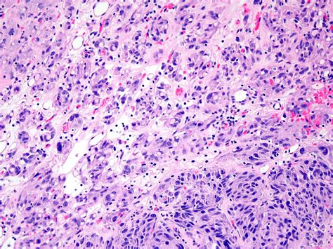 Pathology Outlines Gastrointestinal Stromal Tumor Gist