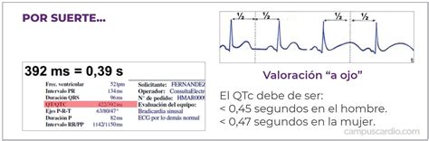 Intervalo Qt Y Qtc 53 Off