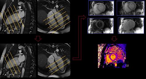 mri cardiac t1 mapping t2 mapping and t2 mapping