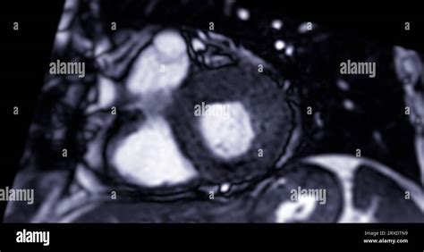 Mri Heart Or Cardiac Mri Magnetic Resonance Imaging Of Heart In