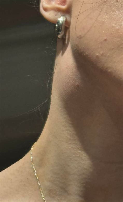 Lump On Lymph Node Rmedicaladvice