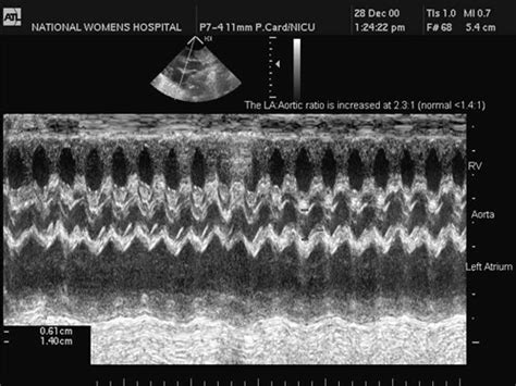 Patent Ductus Arteriosus Pda In The Newborn