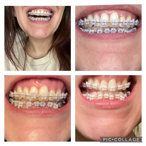 About Three Months In Light Force Braces Rbraces