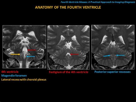 Fourth Ventricle Mri