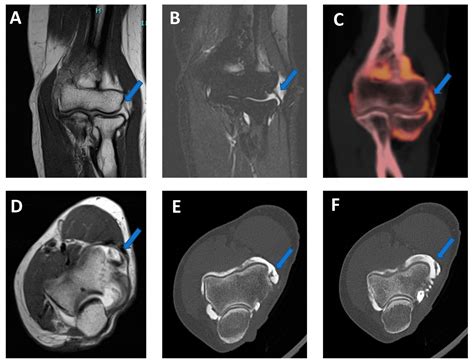 Tomography Free Full Text Dual Energy Ct Arthrography Advanced
