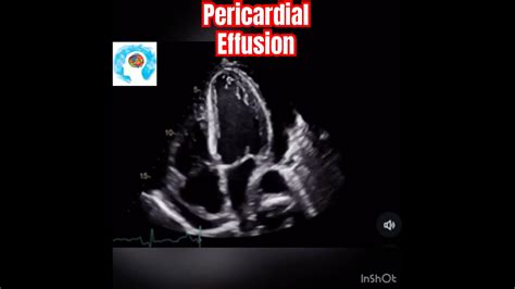 Pericardial Effusion On Cardiac Ultrasound 4 Chambers View Cardio
