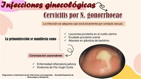 Cervicitis Por N Gonorrhoeae Medicina Óptima Udocz