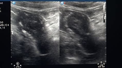 Em Polyp Vs Submucosal Fibroid Youtube