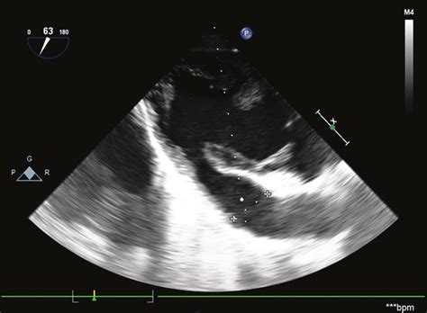 Transgastric Rv Inflow Outflow View Download Scientific Diagram