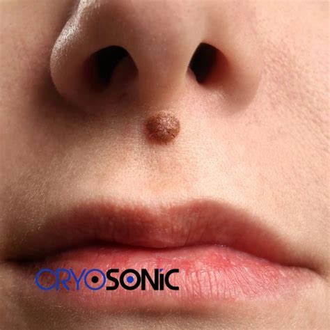 Benign Moles Removal Cirencester Safe Treatment