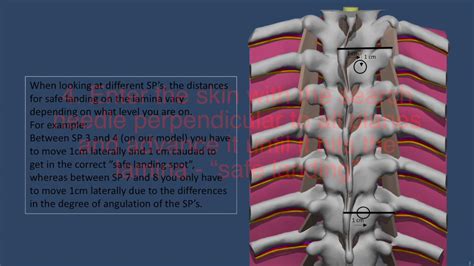 Thoracic Epidural Placement