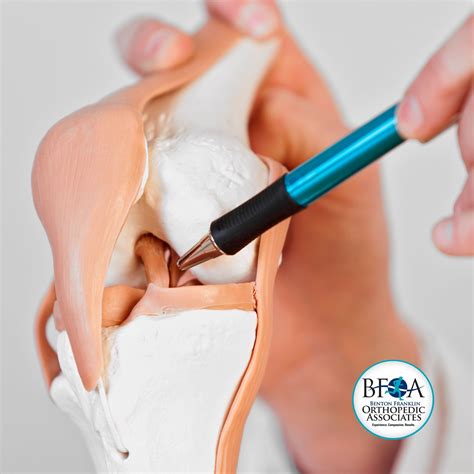 Anterior Cruciate Ligament Acl Tear In Kennewick Wa