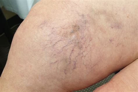 Cosmetic Veins Dr Toby Cohen Cosmetic Veins Dr Toby Cohen