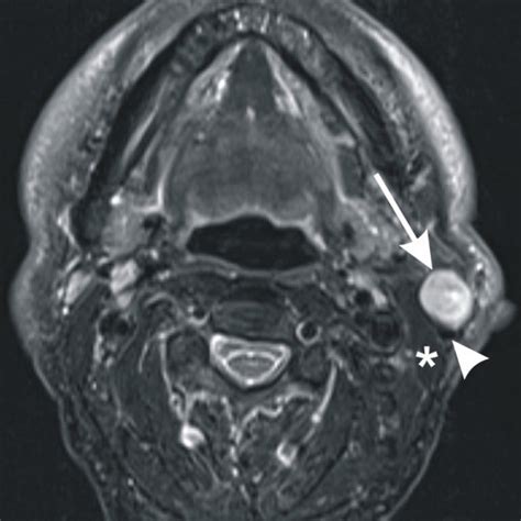 Axial Mr Image T2 Weighted Of A 2 × 2 Cm Mass With Hyperintense