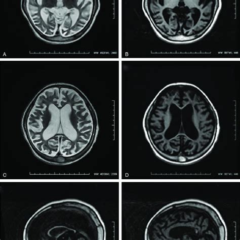A D Diffuse Brain Atrophy E F Corpus Callosum Atrophy Skull