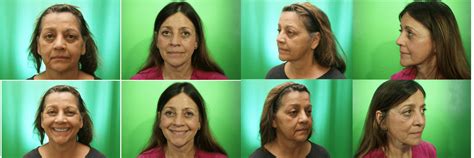 Plastic Surgeon In Poway San Diego Ca