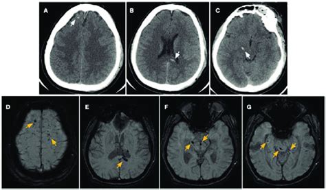 Ct And Swi Mri Scans A C Petechial Hemorrhages In The Right Frontal