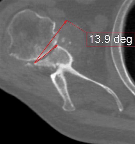 How To Measure Glenoid Bone Stock And Version And Why It Is Important