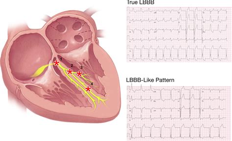 Why Does Stress Make Lbbb Left Bundle Branch Block More Symptomatic Med School Radio